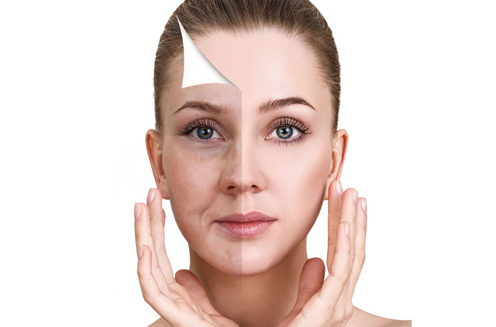 What should you pay attention to after Q switch laser? - Interliva